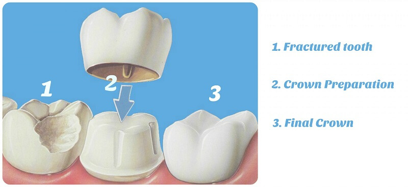 Broken Tooth, Lost fillings, Loose Crowns - Parks Medical Supplies Ltd